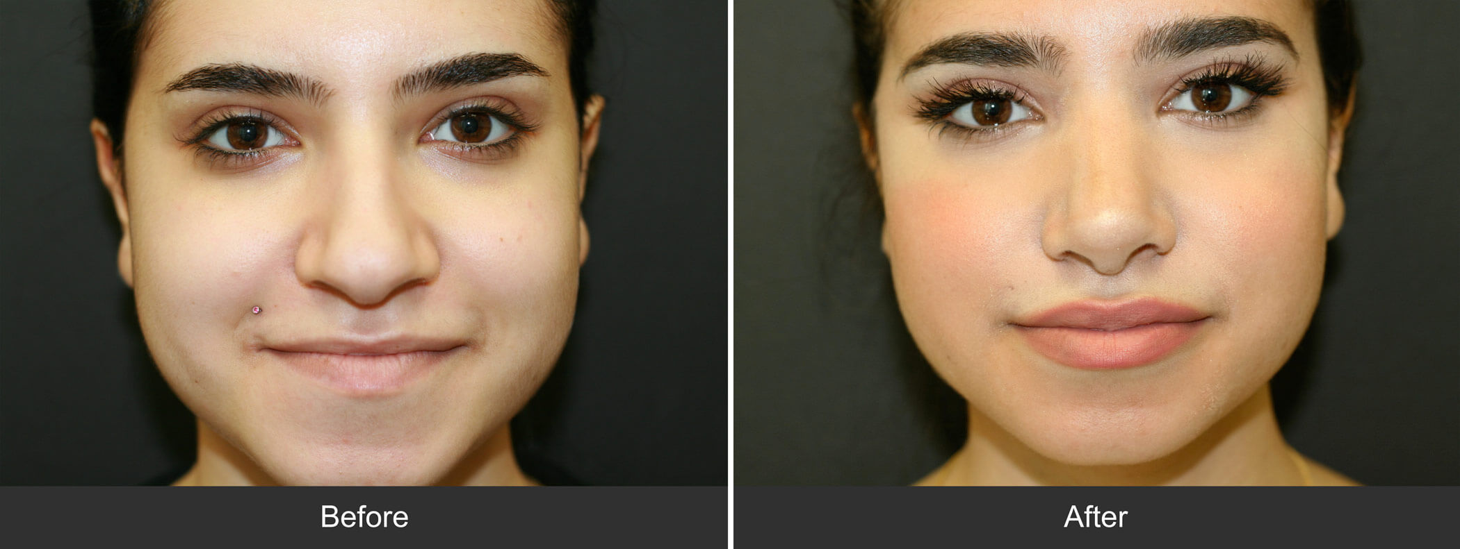 Patient2-front - Burlington Facial Surgery - Dr Korkis